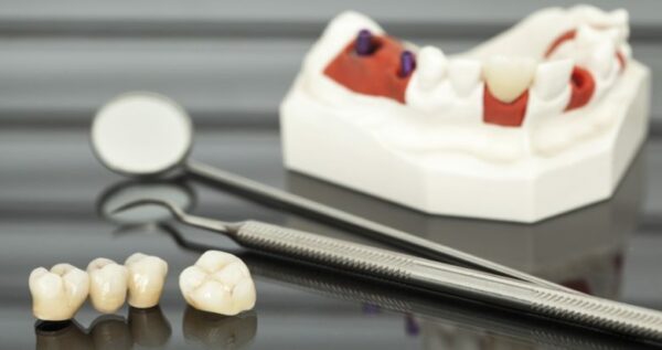 Tannkrone - Romsås Tannlegesenter, Oslo - Tannleger og tannpleier på ...